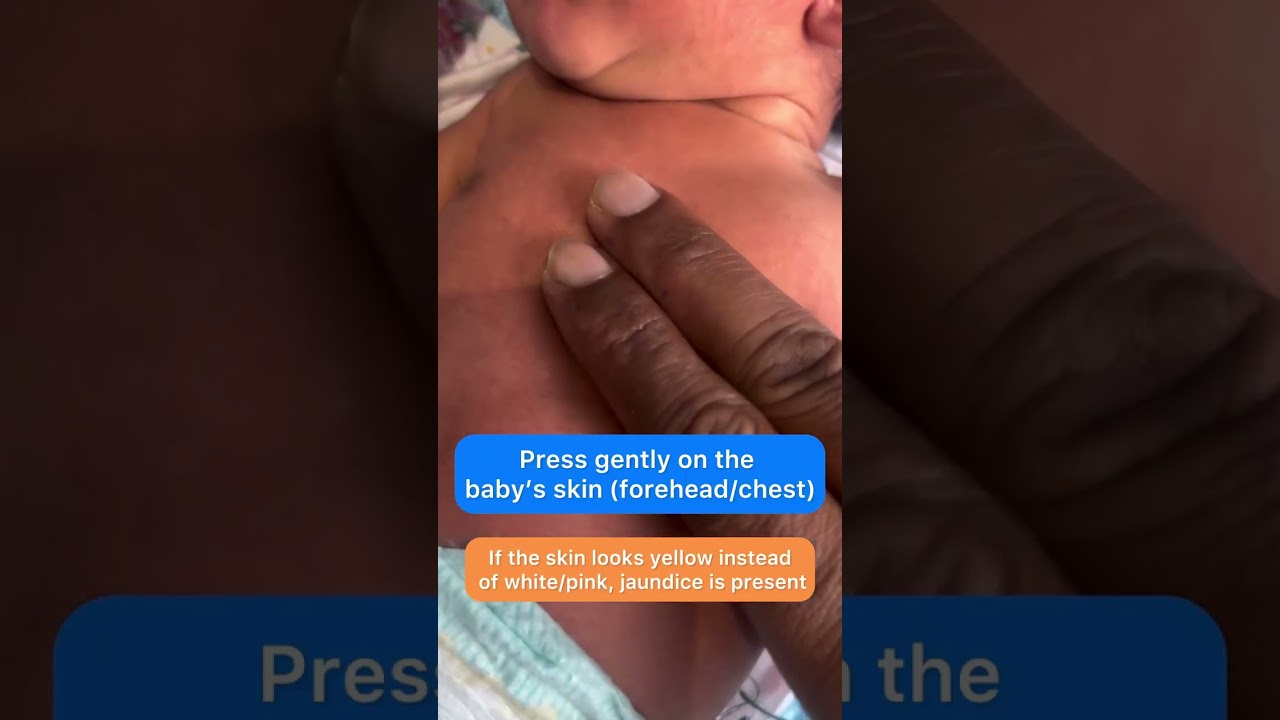 Jaundice Examination #nicu #baby #neonatal #jaundice #jaundicetreatment #picu #nursing #anm #gnm #fy