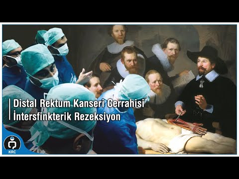 DİSTAL REKTUM KANSERİ CERRAHİSİ - İNTERSFİNKTERİK REZEKSİYON