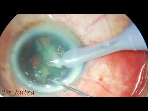 NUCLEAR SCLEROSIS GEADE 2 WITH CORTICAL CATARACT by Dr Jaitra CC#1