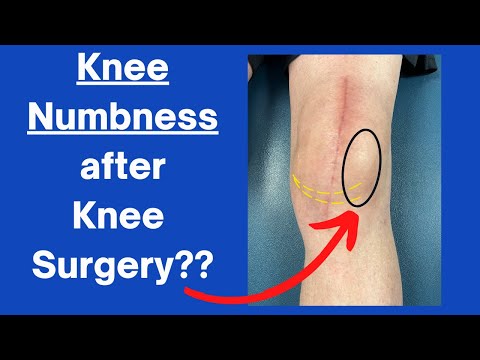 Knee Numbness after Knee Surgery??