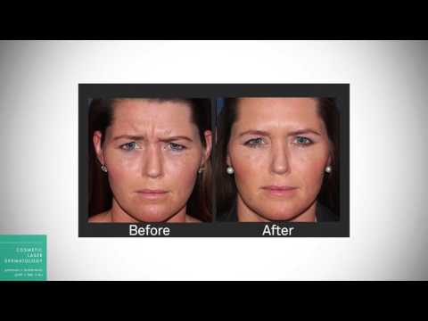 What to Expect From Botox Injections