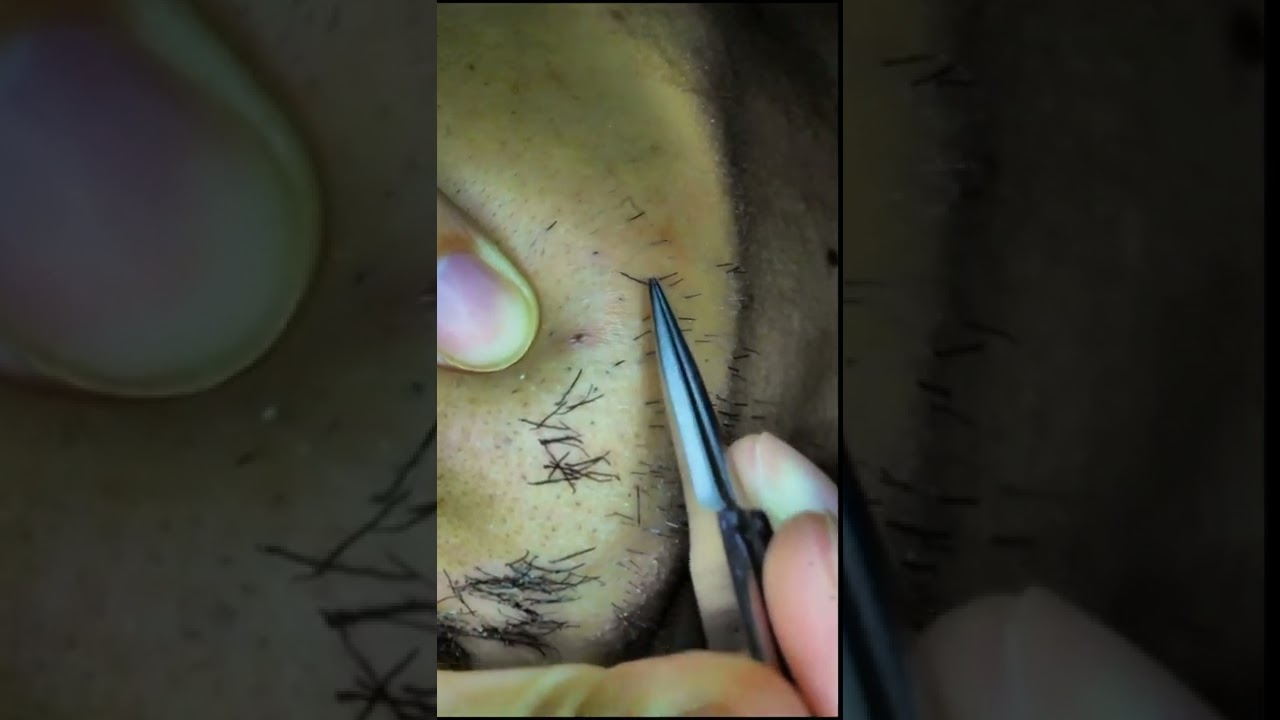 Super Satisfying Ingrown Hair Removal Ingrown Hair Removal 2022 Compilation11 #shorts