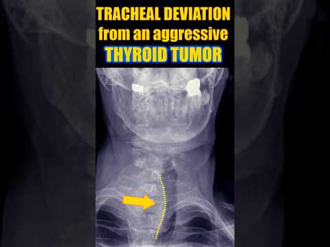 Thyroid Tumor #radiology #doctor #thyroid