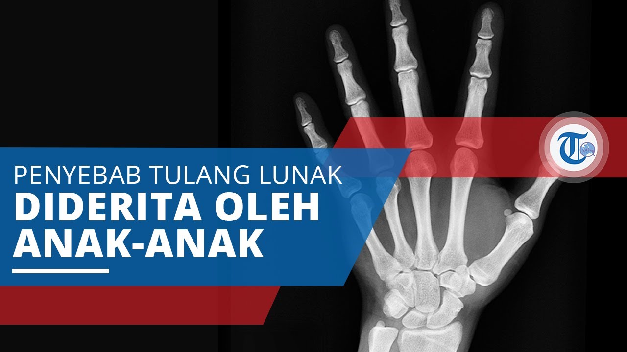 Rakitis, Kelainan Tulang yang Menyebabkan Tulang Rapuh, Mudah Patah dan ...