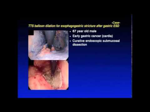 Therapeutic Endoscopy for Strictures of the Upper Digestive Tract (DV046)