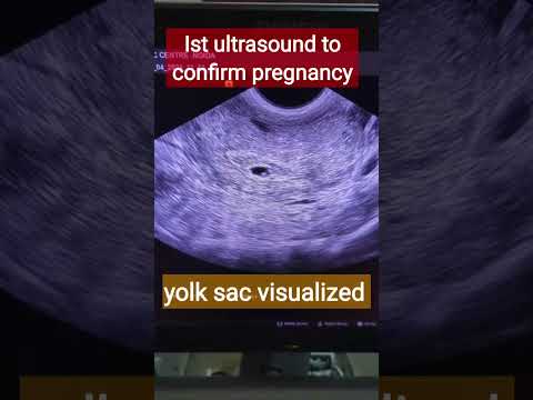 1st ultrasound to confirm pregnancy/ Gestational sac kya hota hai