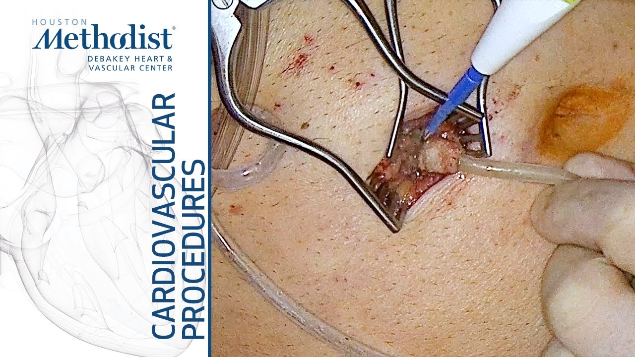 Peritoneal Dialysis Catheter Removal (Eric K. Peden, MD, M. Mujeeb Zubair, MD)
