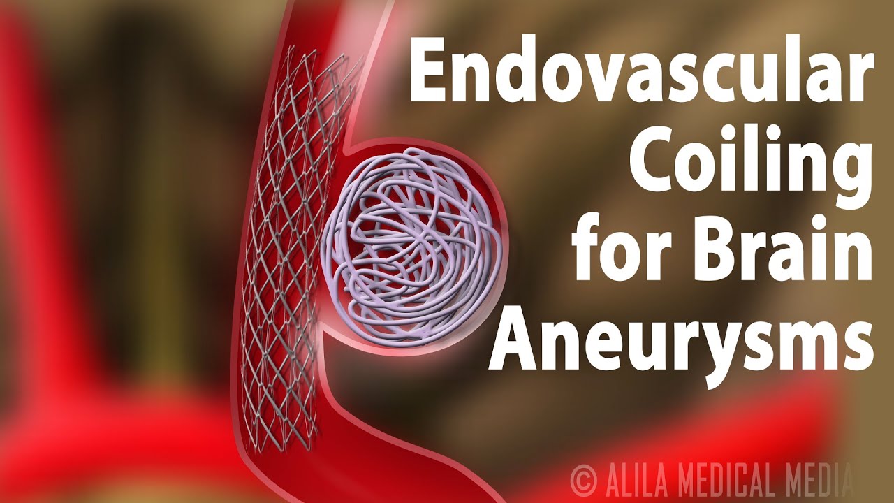 Endovascular Coiling for Brain Aneurysm, Animation.