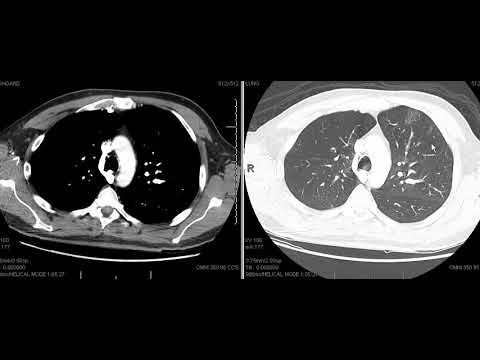 Pulmonary Embolism (PE) Radiology case
