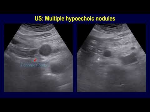 Subhepatic hypoechoic nodules in a postop RCC pt: pancreatic metastasis