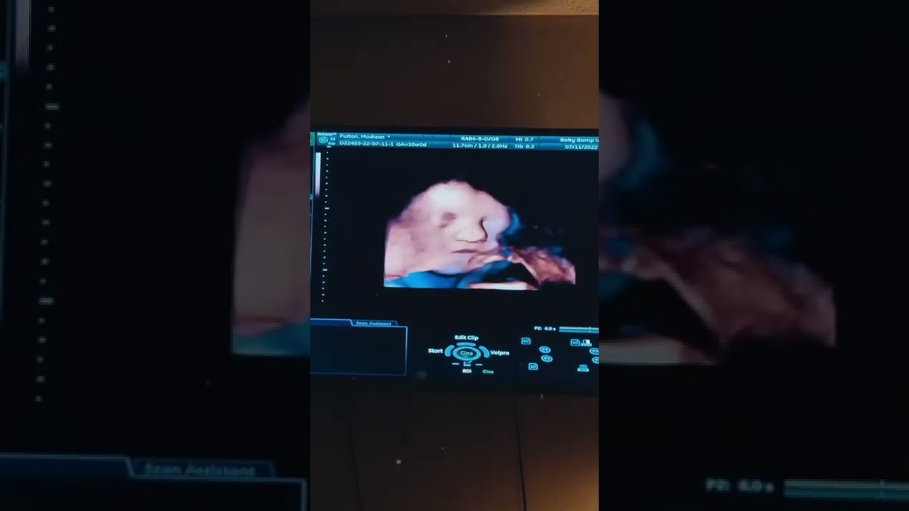 Kylands 4D ultra sound 🥹