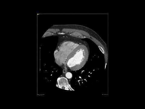 Looking Inside a CCTA with Dr. Hota at Atlantic Medical Imaging