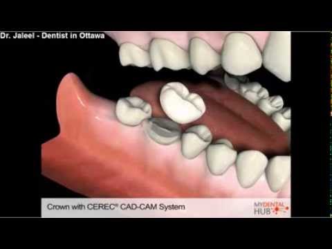 Esthetics And Restorative - Crown With CEREC CAD CAM System - Dentist Ottawa
