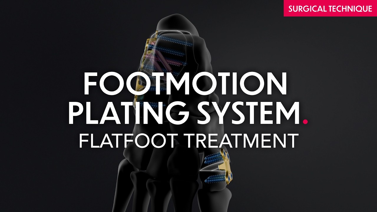 Footmotion Plating System - Flatfoot treatment - Surgical technique