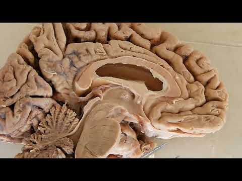 Third Ventricle / neuroanatomy / boundaries / recesses