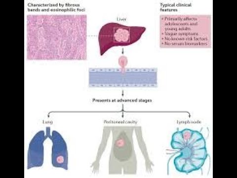 Fibrolamellar Hepatocellular carcinoma ; Definition, Histology, Symptoms, Diagnosis, Treatment