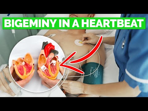 What is BIGEMINY? Causes & Preventions | Cardiac Arrhythmia Explained