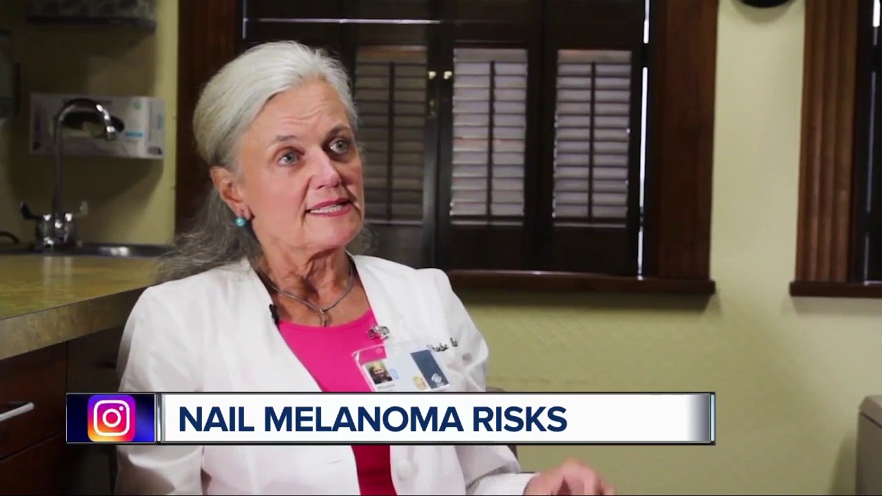 Nail melanomas