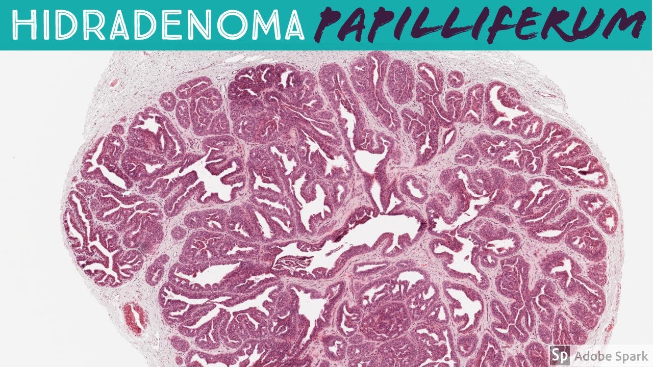 Hidradenoma Papilliferum: 5-Minute Pathology Pearls