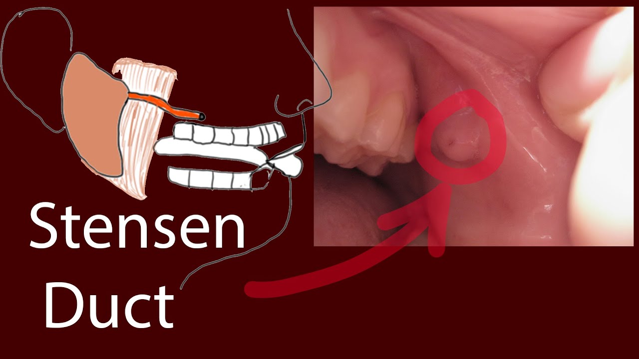 Bump inside mouth - Parotid duct Diseases. Stensen duct; Sialolithiasis