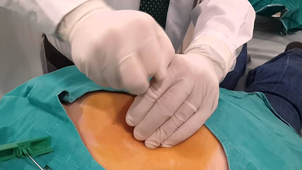 CT-GUIDED BONE BIOPSY