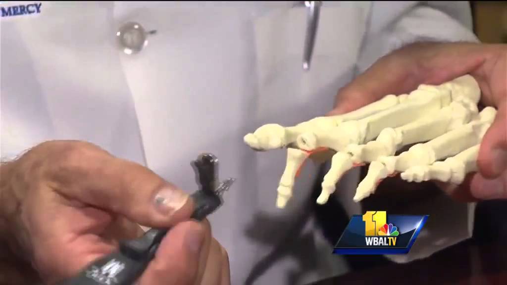 Doctors: Hammertoe correctable with surgery
