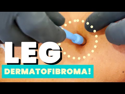 LEG DERMATOFIBROMA!