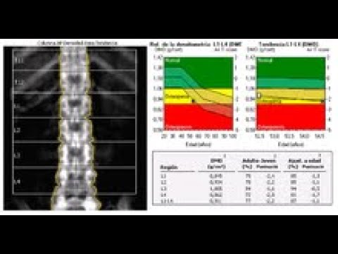 O que é Osteopenia?