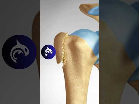 Proximal Humeral Fracture of the Shoulder - #4K #3D #animation
