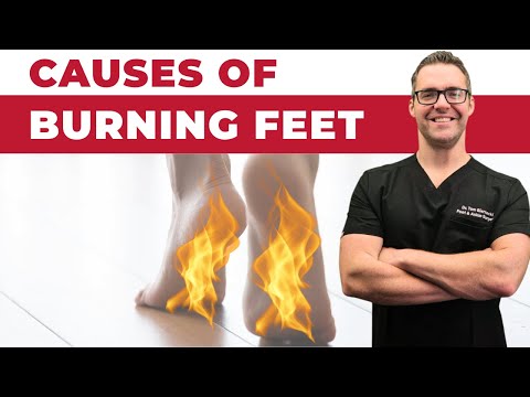 Top 11 Causes & Treatments of Burning Feet!