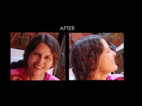 Christina, age 59 looks 20 years younger... She had a full facelift with Dr Koelliker