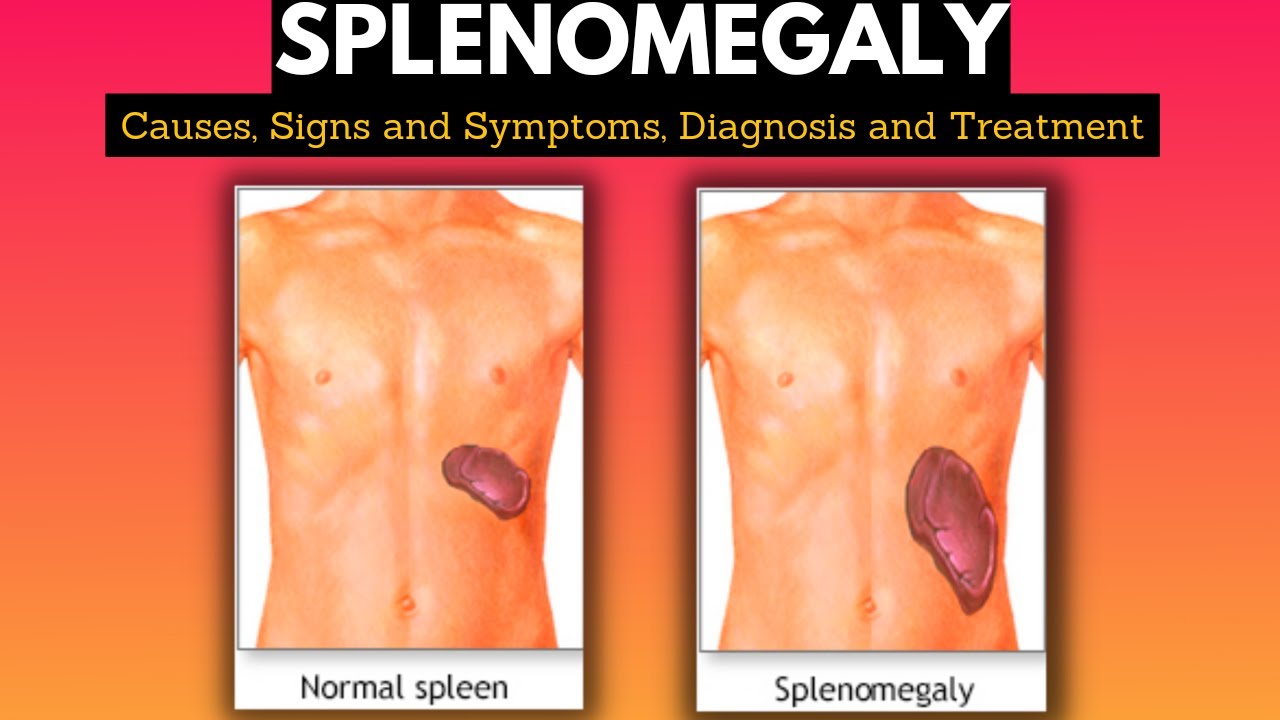 Splenomegaly, Causes, Signs and Symptoms, Diagnosis and Treatment