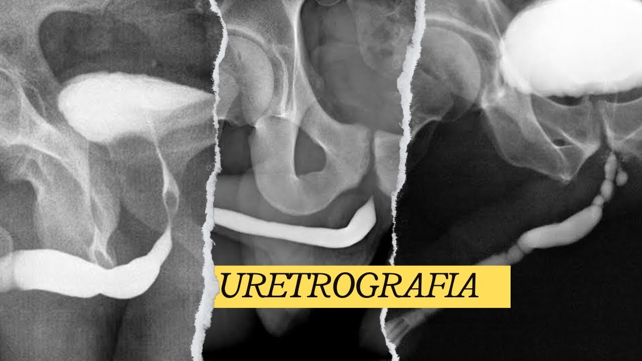 URETHROGRAPHY | RADIOLOGICAL STUDY #radiology #radiology #anatomy