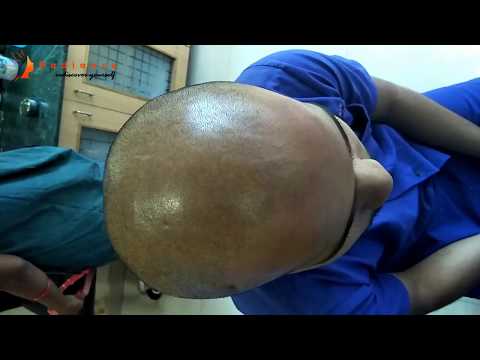 viral video hair transplant at radiance clinic bhubaneswar