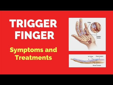 Trigger Finger: SYMPTOMS AND TREATMENTS