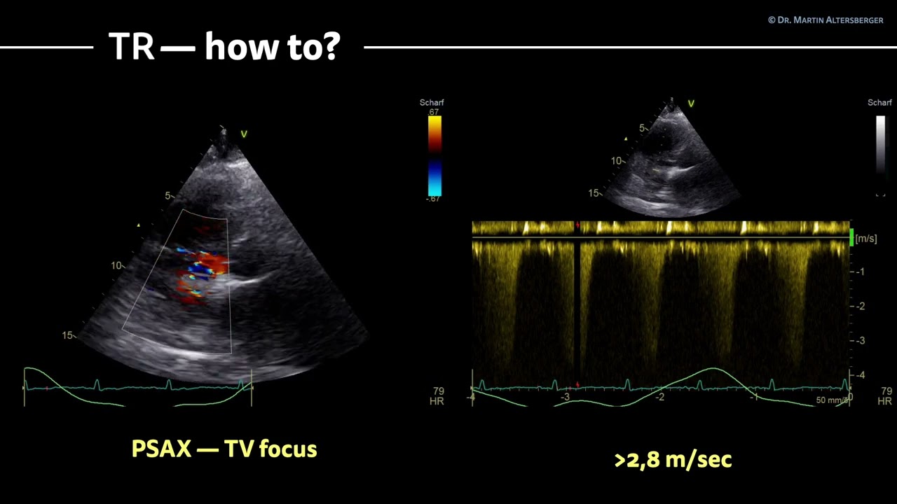 〖Echocardiography〗 Diastolic dysfunction VIII - how to measure 🫀