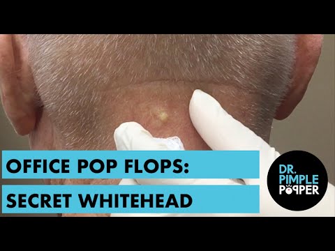 Dr. Pimple Popper Pops Year-Old Neck Whitehead In Youtube Video