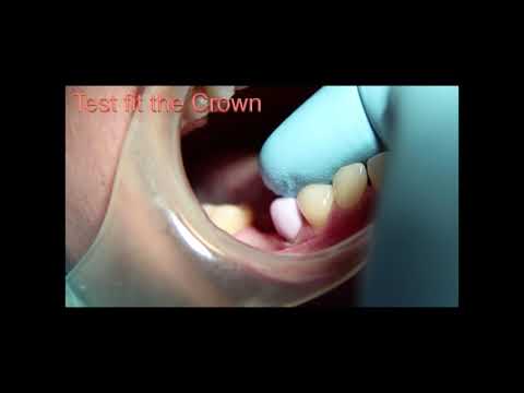 Crown in A Day Maui - How we do it at Miyamoto Dental Design Suite - Dentist Maui HI
