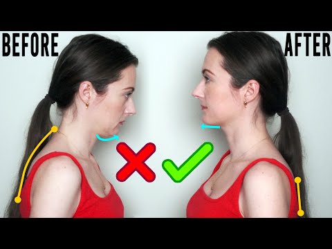 Mewing before and after | 2+ Years of tongue posture exercises