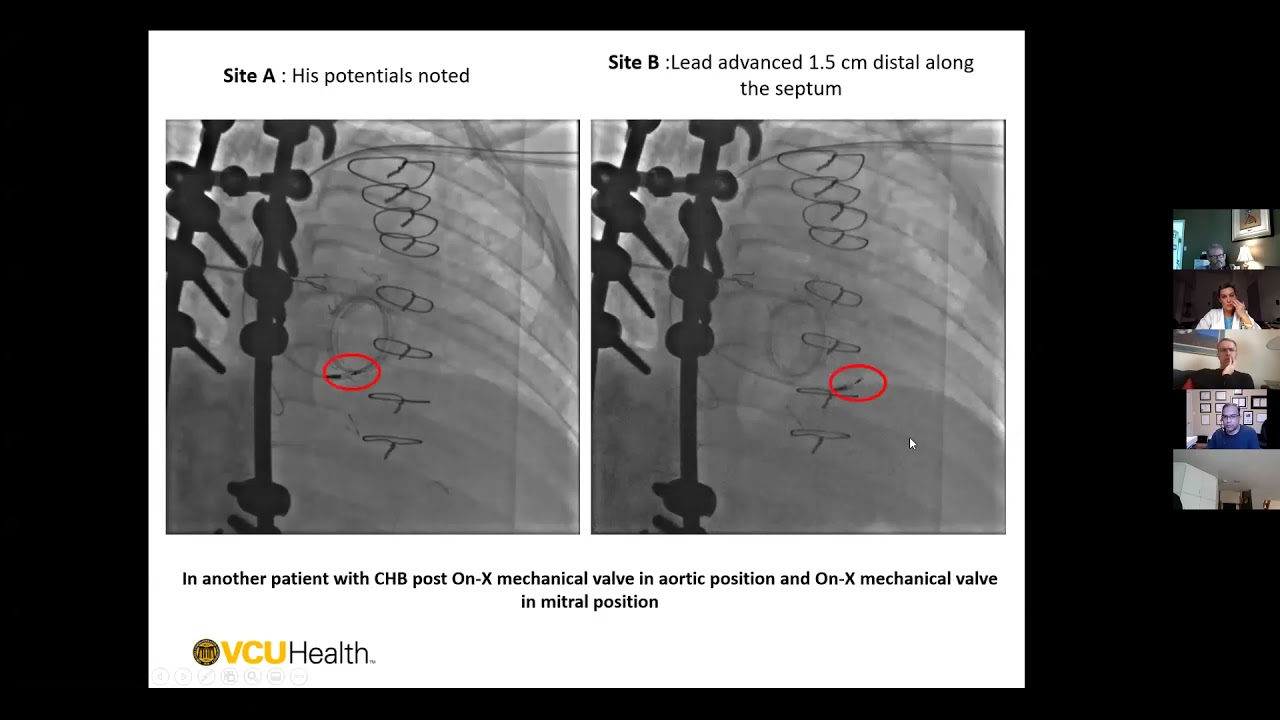 Left Bundle Branch Pacing Webinar, Session 2