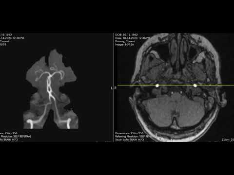 Basilar artery fenestration