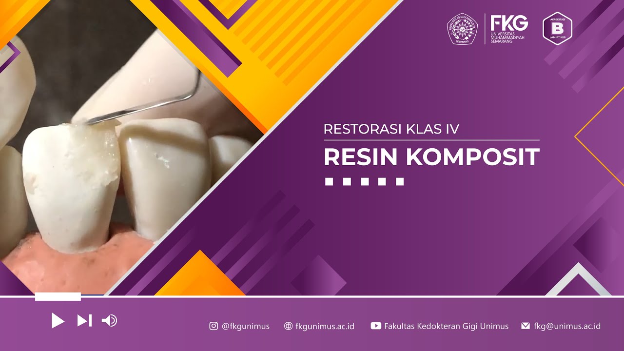 Restorasi Klas IV dengan Resin Komposit