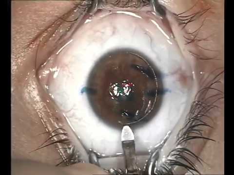 LASIK - Dr. L. Gauthier-Fournier - Cleaver for LASIK enhancement - MORIA