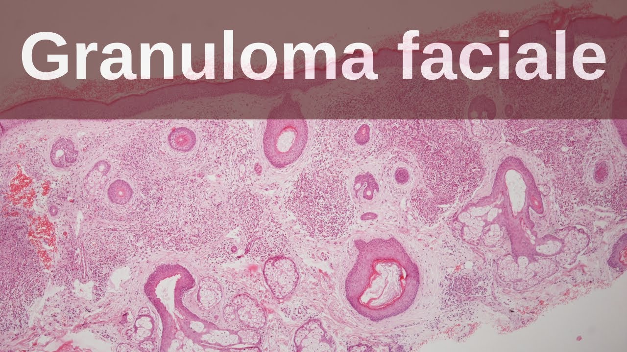 Granuloma Faciale - Pathology mini tutorial