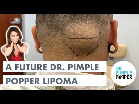 Dr. Pimple Popper Removes Scalp Lipoma In New YouTube Video