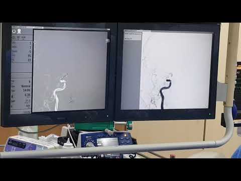 ICAD BRAIN STENTING IN ACUTE STROKE