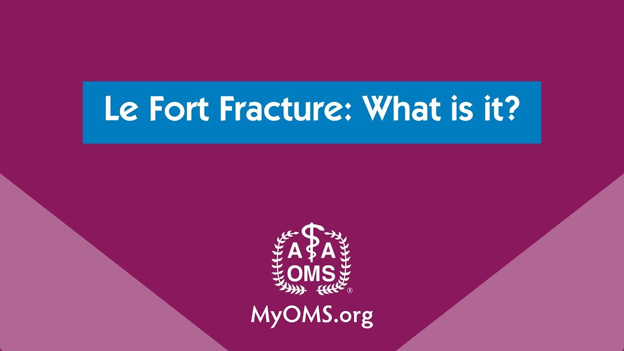 Le Fort Fracture: What is it?