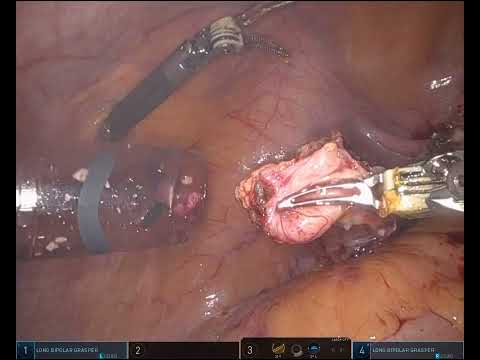 Always do lysis of adhesions and reconstruct anatomy prior to doing a Laparoscopic hysterectomy