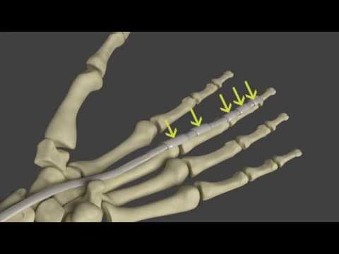 Trigger Finger: Symptoms and Anatomy