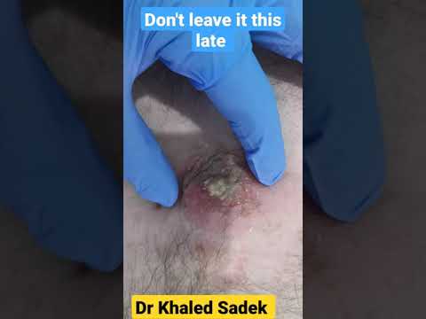 massive cyst infection #cystremoval Dr Khaled Sadek